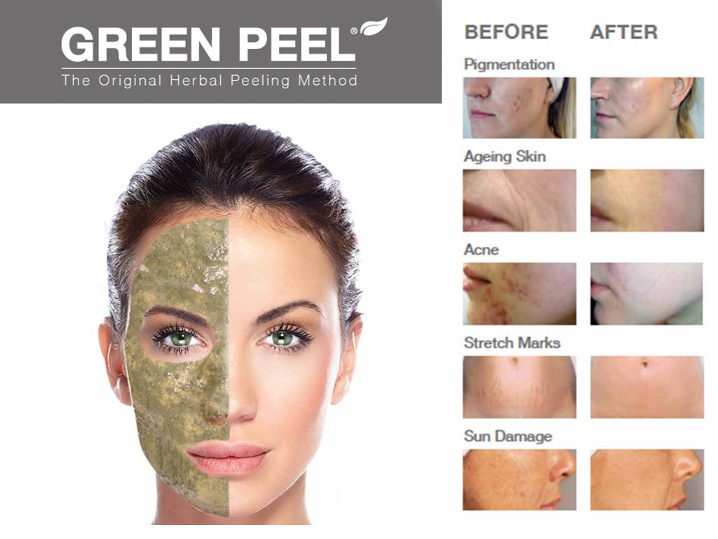 Green Peel Fresh Up Light – Emporium Treatment Clinic